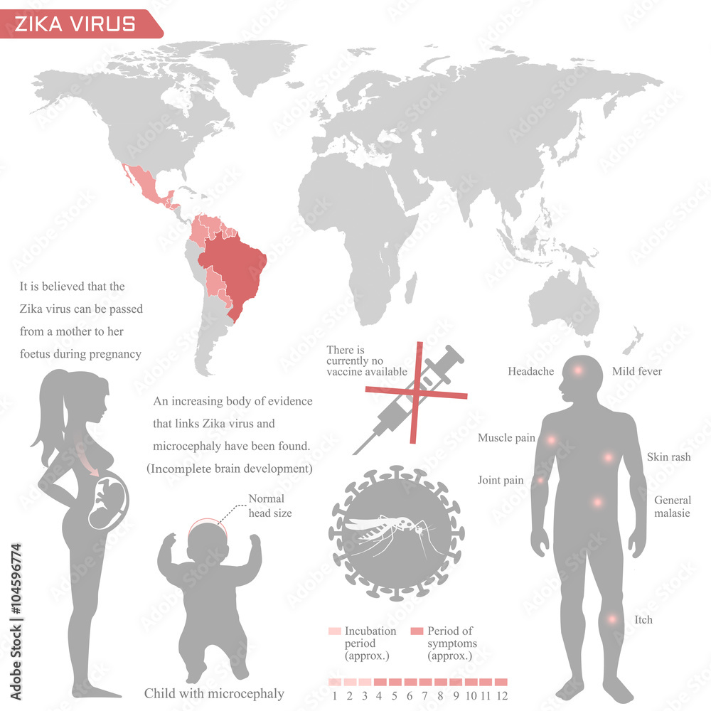 Zika virus infographic: prevention, symptoms and treatment Stock Vector ...