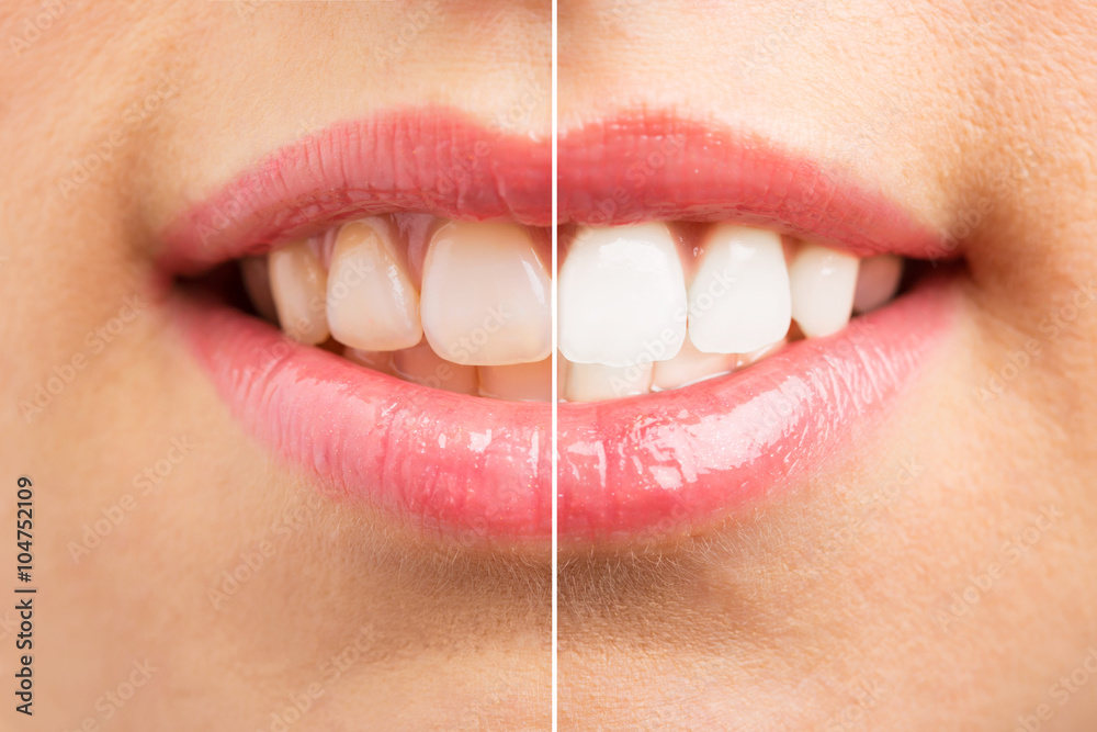 Teeth before and after whitening Stock Photo | Adobe Stock