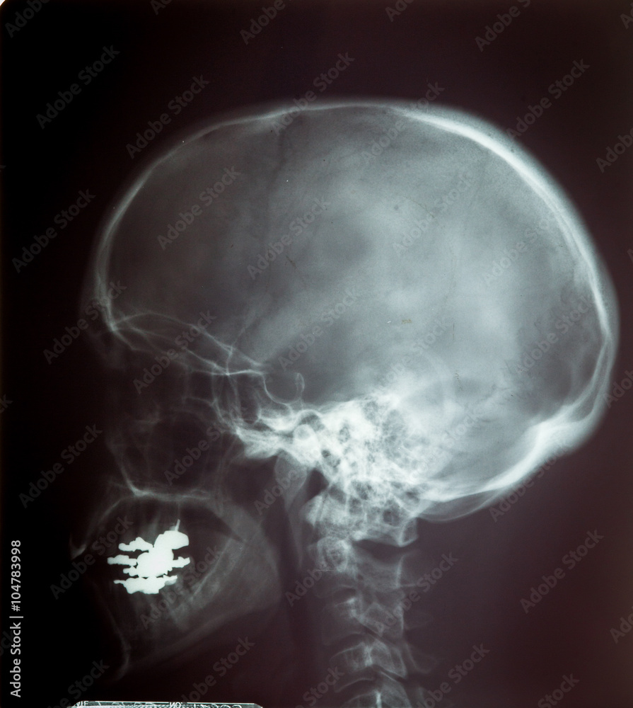 X ray MRI - Image of Spinal Column Neck pain and Skull Head Stre Stock ...