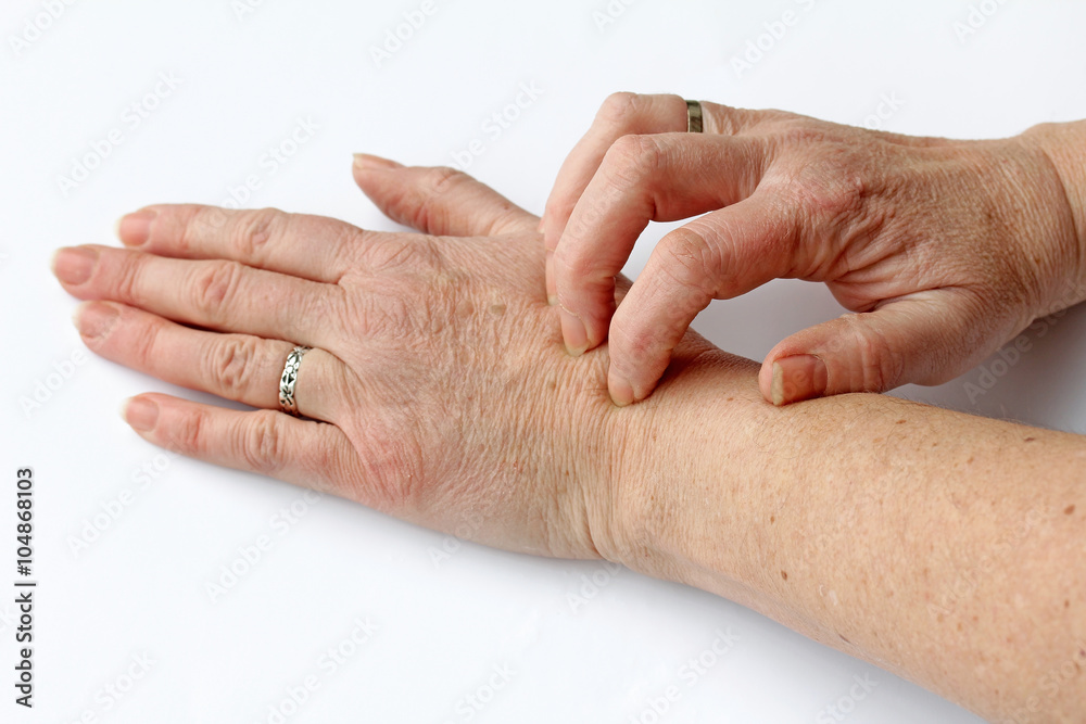 Juckende trockene Haut an Händen und Armen Stock Photo | Adobe Stock