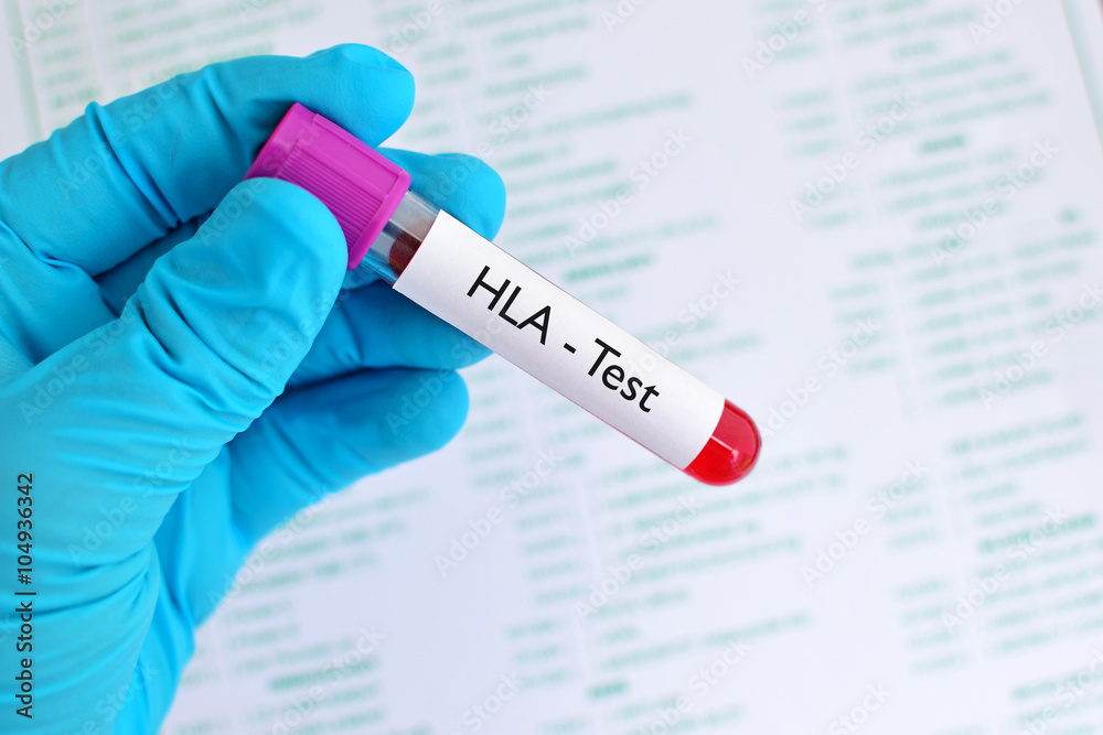Blood sample for HLA (Human Leukocyte Antigen) test Stock Photo | Adobe ...