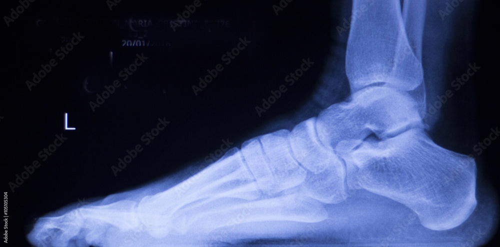 Foot and toes injury xray scan Stock Photo | Adobe Stock