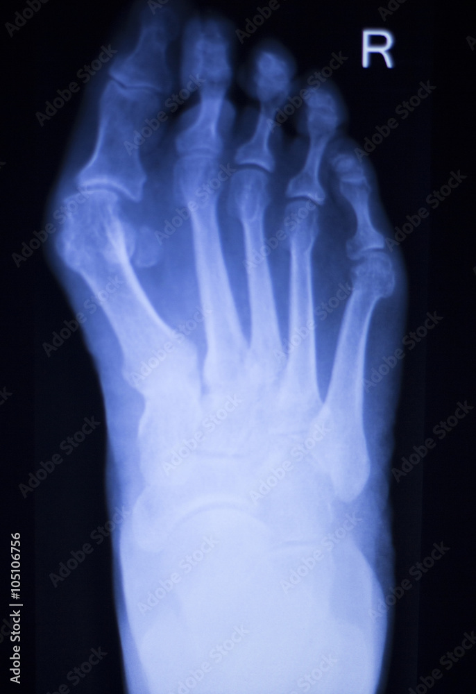 Foot and toes injury xray scan Stock Illustration | Adobe Stock