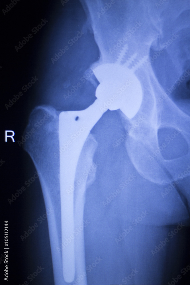 Hip replacement xray orthopedic medical scan Stock Photo | Adobe Stock