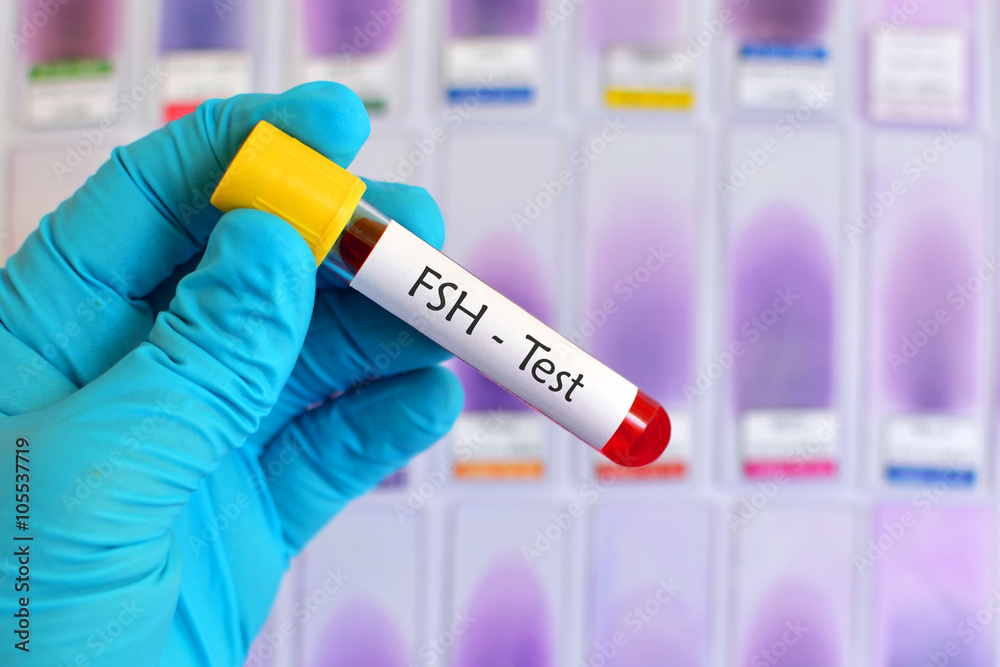 Test tube with blood sample for follicle stimulating hormone (FSH) test ...