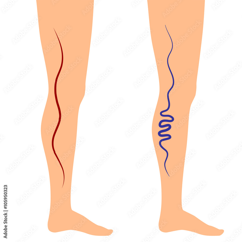 Vector illustration leg veins Stock Vector | Adobe Stock