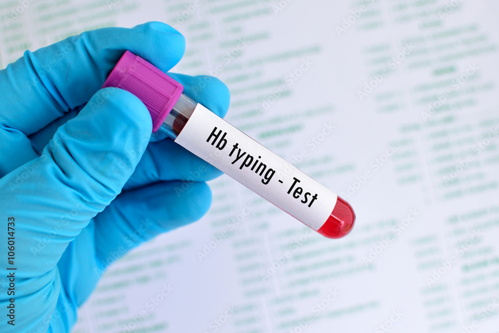 Blood sample for hemoglobin (Hb) typing test, thalassemia diagnosis ...