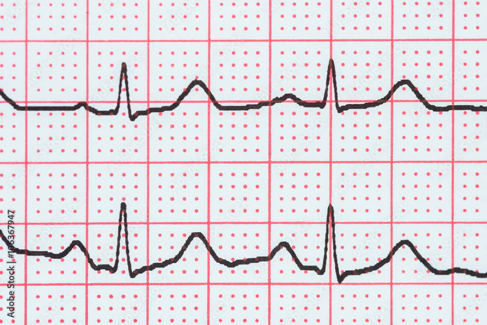 Sinus Heart Rhythm On Electrocardiogram Record Paper Showing Normal P ...