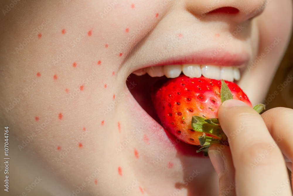 Allergy food strawberry and abstract allergic reaction on the girl's ...