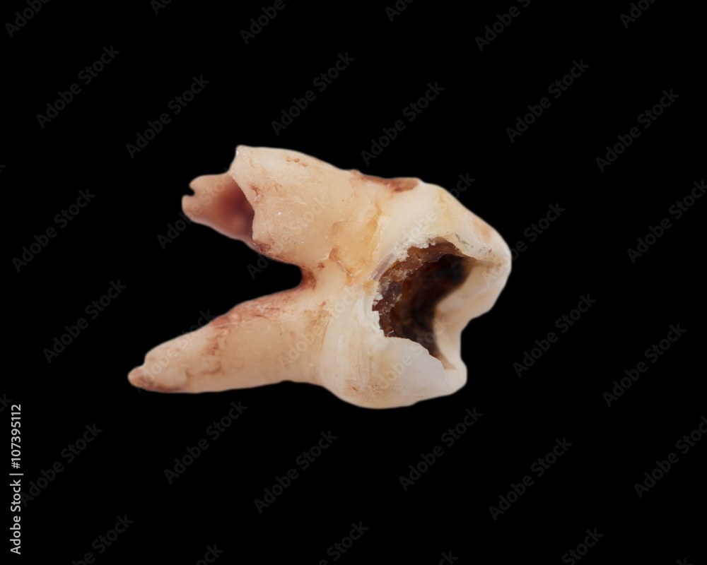 extracted tooth with caries on a black background Stock Photo | Adobe Stock