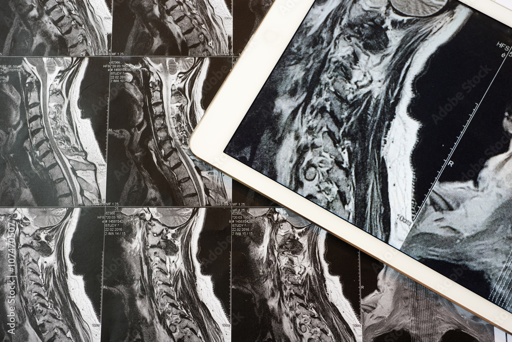 MRI Pictures of spinal column with magnification on overlaying t Stock ...