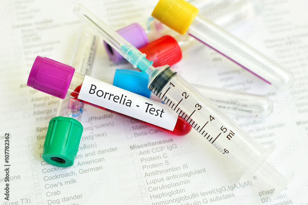 Blood sample for Borrelia test (Lyme disease diagnosis) Stock Photo ...
