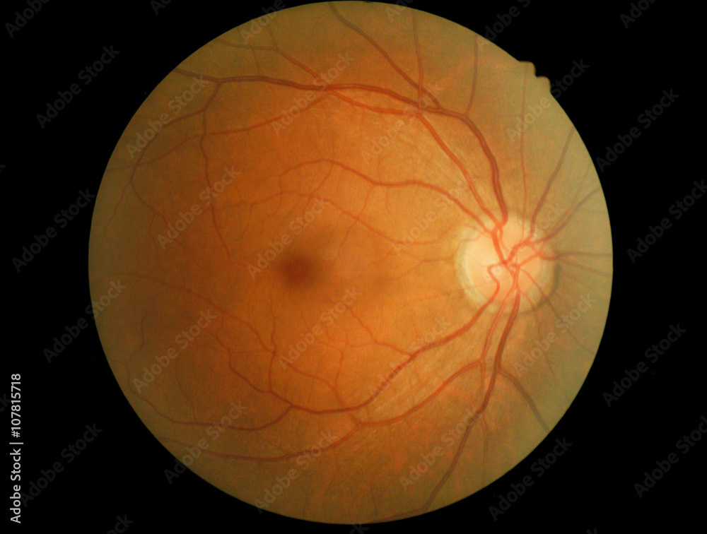 Human eye anatomy, retina, optic disc artery and vein etc. takin Stock ...