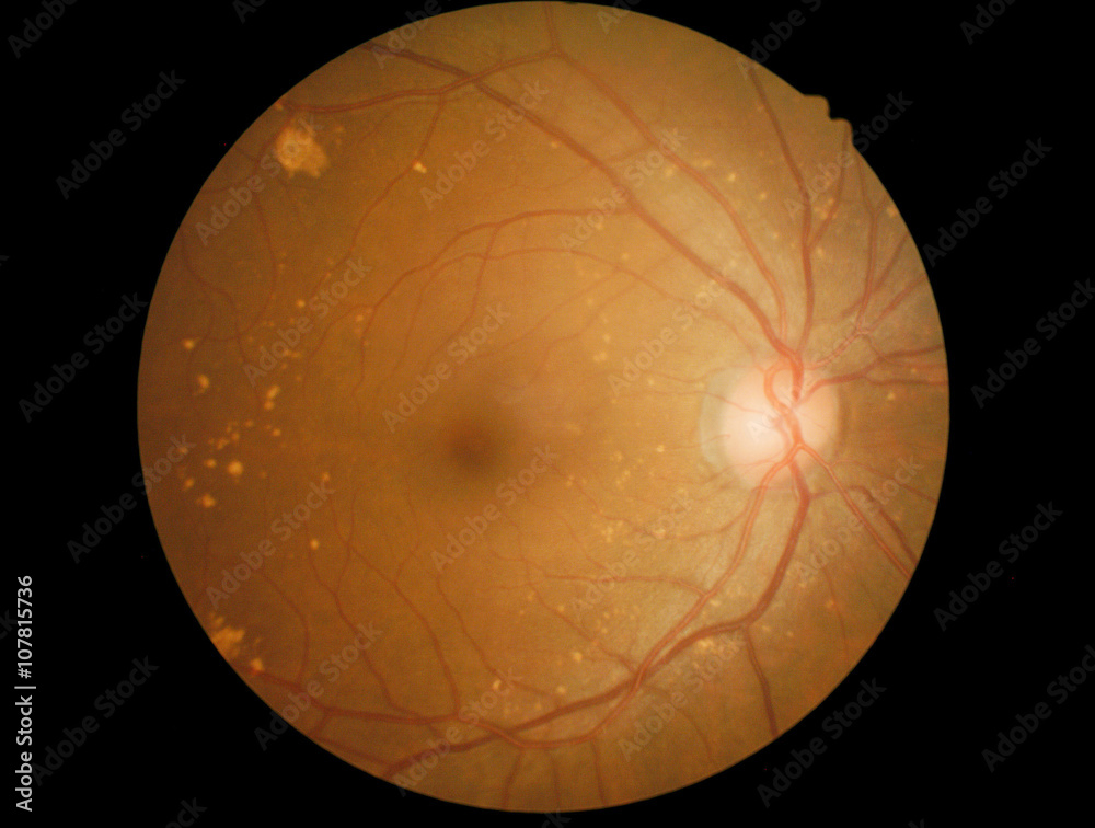 Human eye anatomy, retina, optic disc artery and vein etc. takin Stock ...