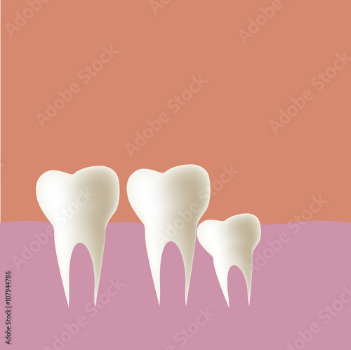 Wisdom tooth (Partial Eruption) in mouth, Vector illustration. Stock ...