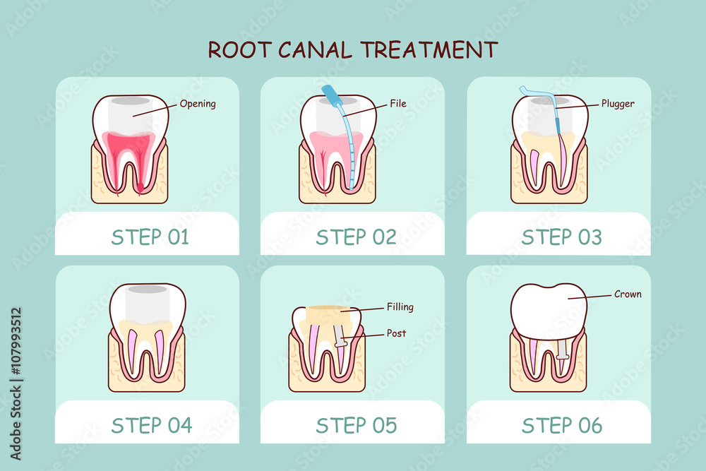 cartoon tooth root canal treatment Stock Vector | Adobe Stock