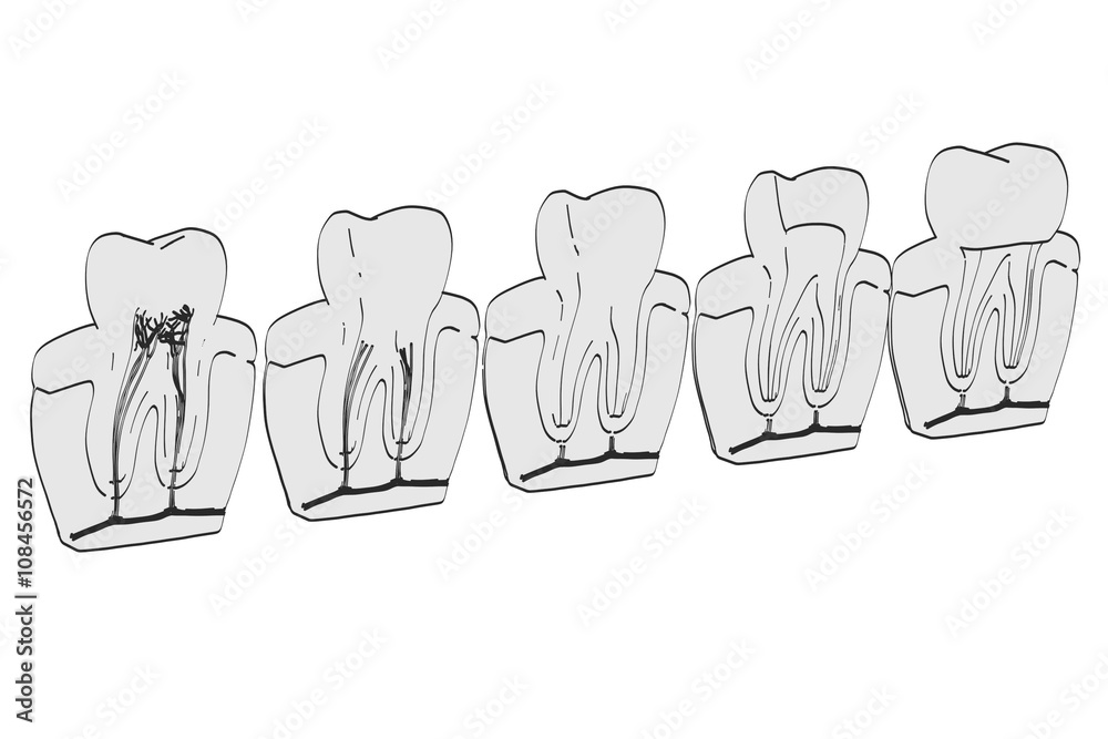 2d cartoon illustration of endodontics Stock Illustration | Adobe Stock