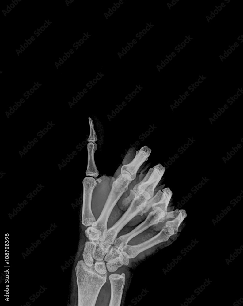 Human hand x-ray - Medical Image. Stock Photo | Adobe Stock