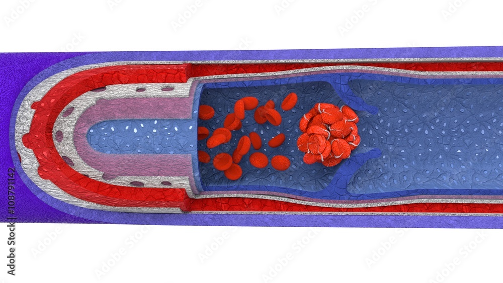 clot, blood clot in the vein. blood poisoning or cancer, on a white ...