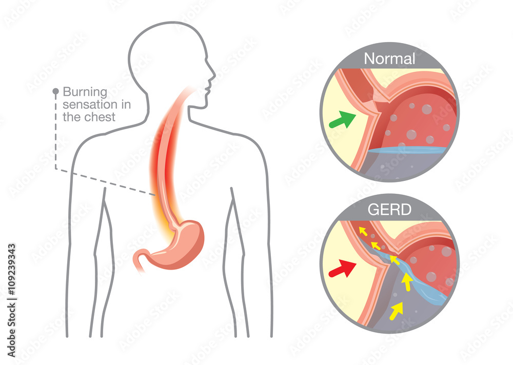 Picture of human stomach in problem area have acid back up into ...