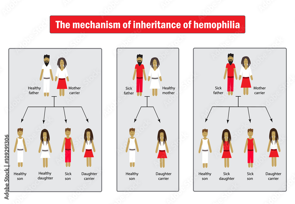 The mechanism of inheritance of hemophilia. Infographics. Vector illustration on isolated ...