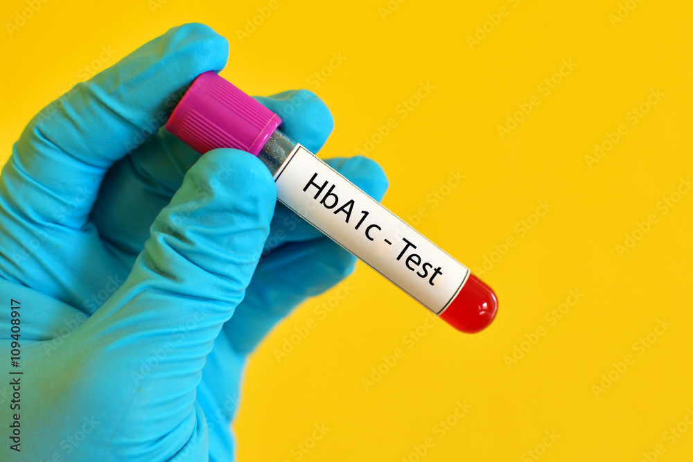 Hemoglobin A1c HbA1c Test Diabetes Diagnosis Stock Photo Adobe Stock hemoglobin-a1c-hba1c-test-diabetes-diagnosis-stock-photo-adobe-stock