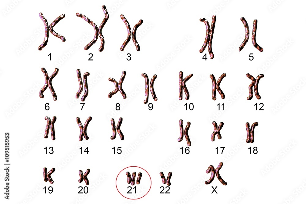 Down-syndrome karyotype, female, labeled, isolated on white background ...
