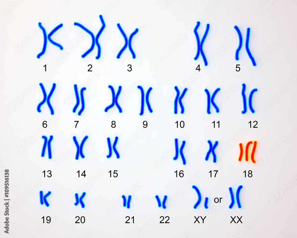 Edwards-syndrome karyotype, labeled. Trisomy 18. 3D illustration Stock ...