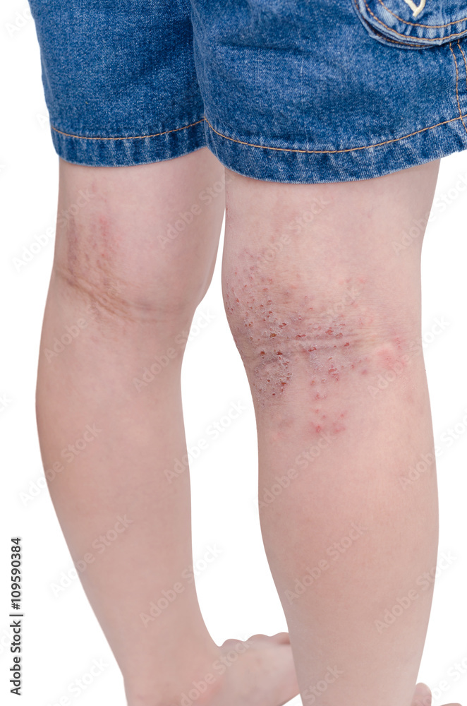 Leg with sore from scratching over white background Stock Photo | Adobe ...