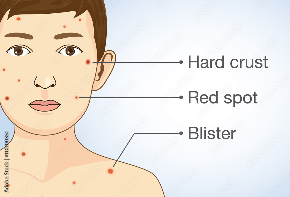 Vetor de Diagram of the varicella infection in a child. The primary ...