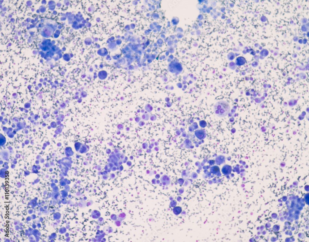 Cancer Cell in human showing abnormal cells. Stock Photo | Adobe Stock