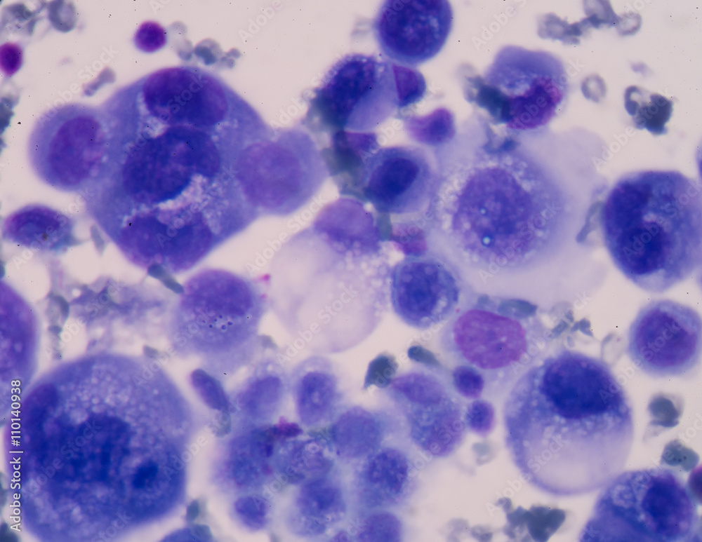 Cancer Cell in human showing abnormal cells. Stock Photo | Adobe Stock