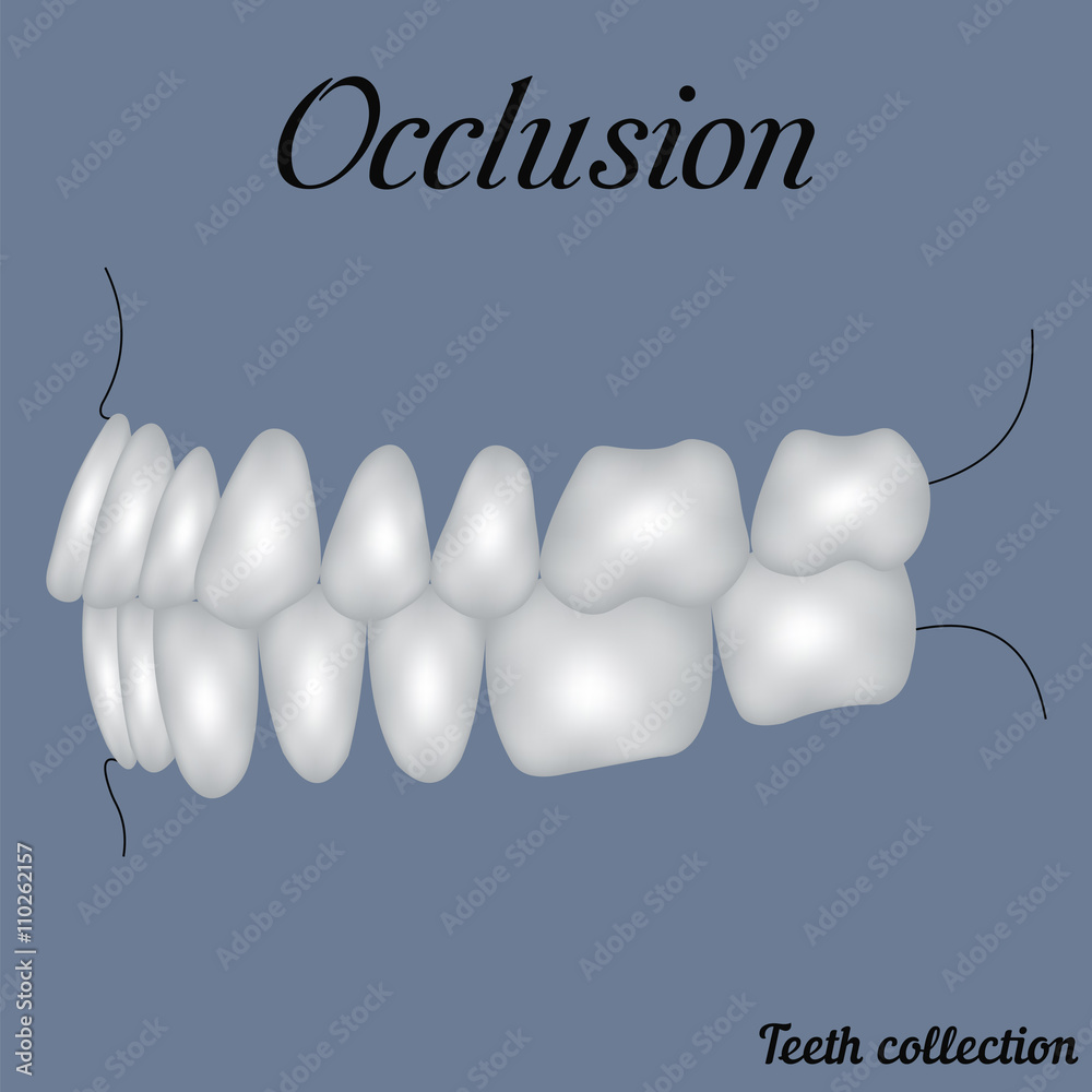 occlusion side view Stock Vector | Adobe Stock