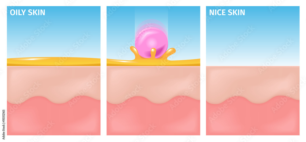 oily skin vector, before after Stock Vector | Adobe Stock