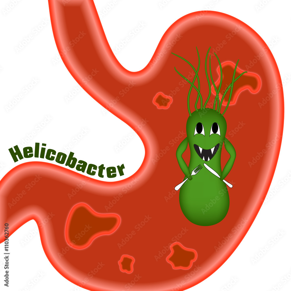 Helicobacter pylori. Ulcers. The disease of the stomach and duodenum ...