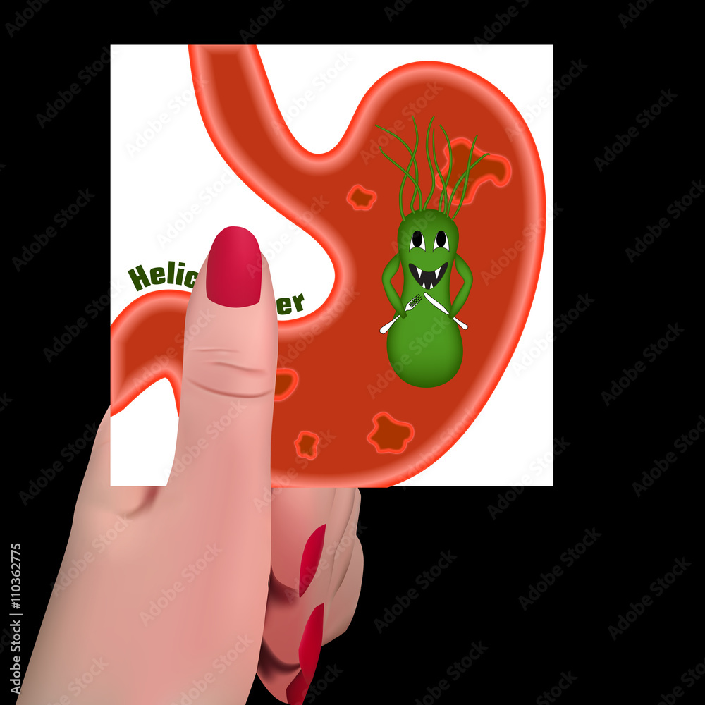 Helicobacter pylori. Ulcers. The disease of the stomach and duodenum ...