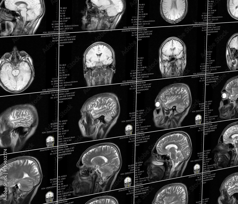 Magnetic resonance imaging of the brain with no visible abnormalities ...