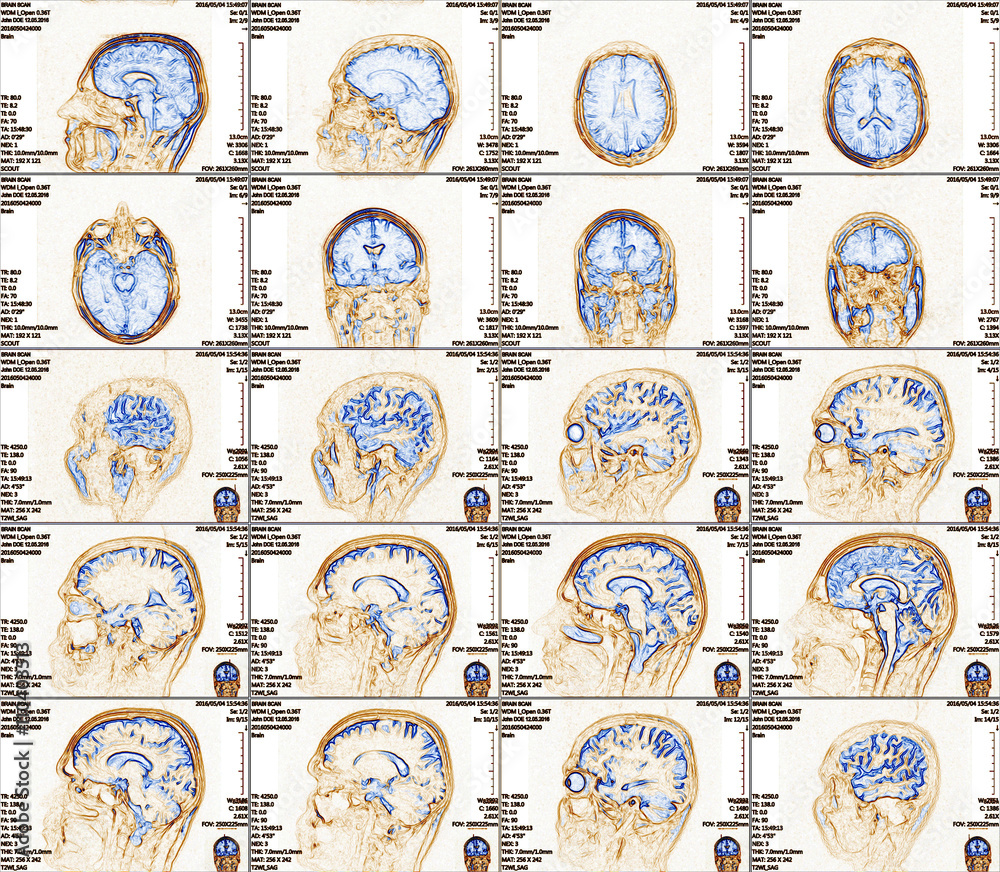 Magnetic resonance imaging of the brain with no visible abnormalities ...