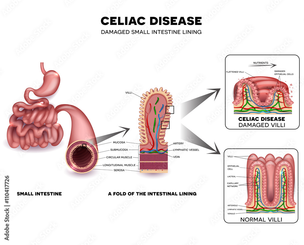 Celiac disease detailed anatomy, healthy intestinal villi and damaged ...