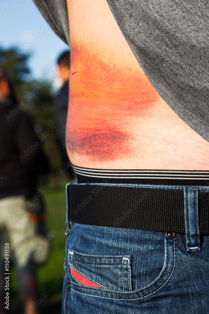 Person revealing an extravasation injury Stock Photo | Adobe Stock