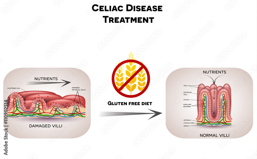 Celiac disease treatment. Gluten free diet leads to healthy intestinal ...