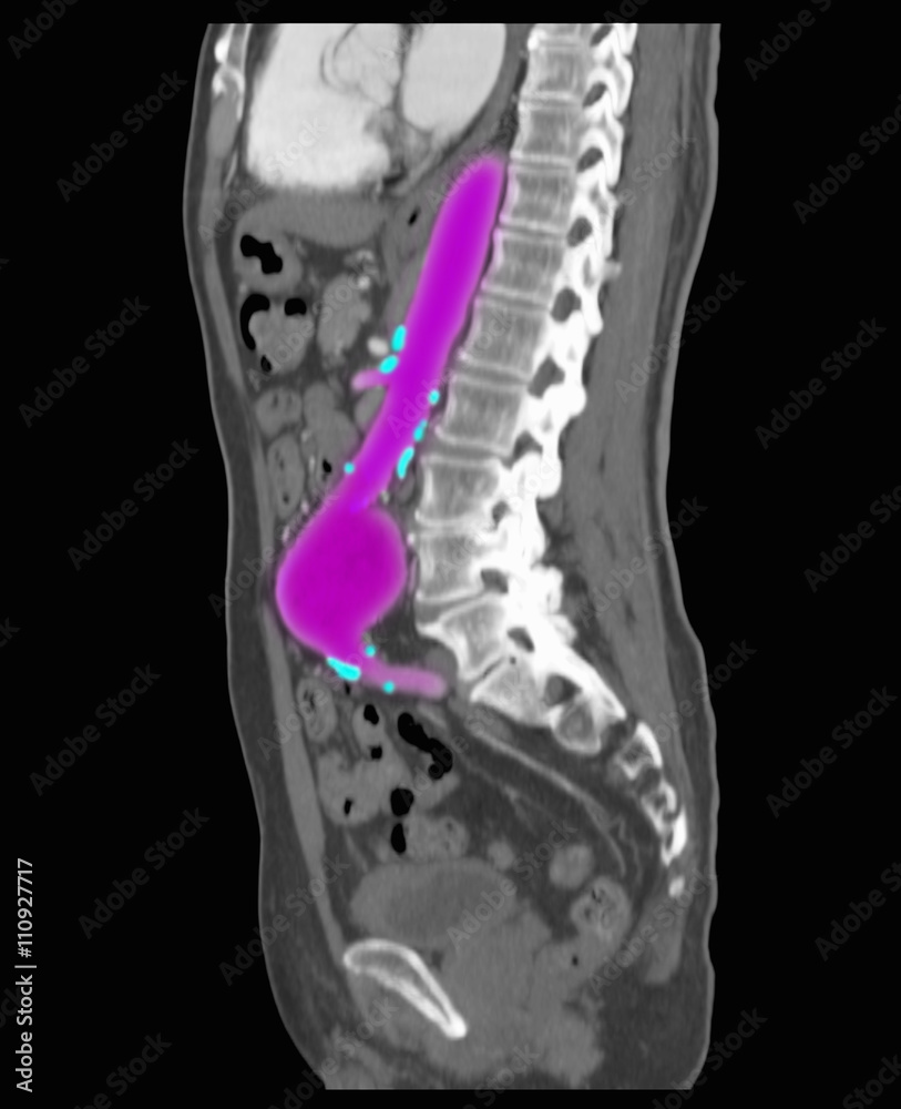 Abdominal angiographic CT scan showing a large abdominal aortic ...