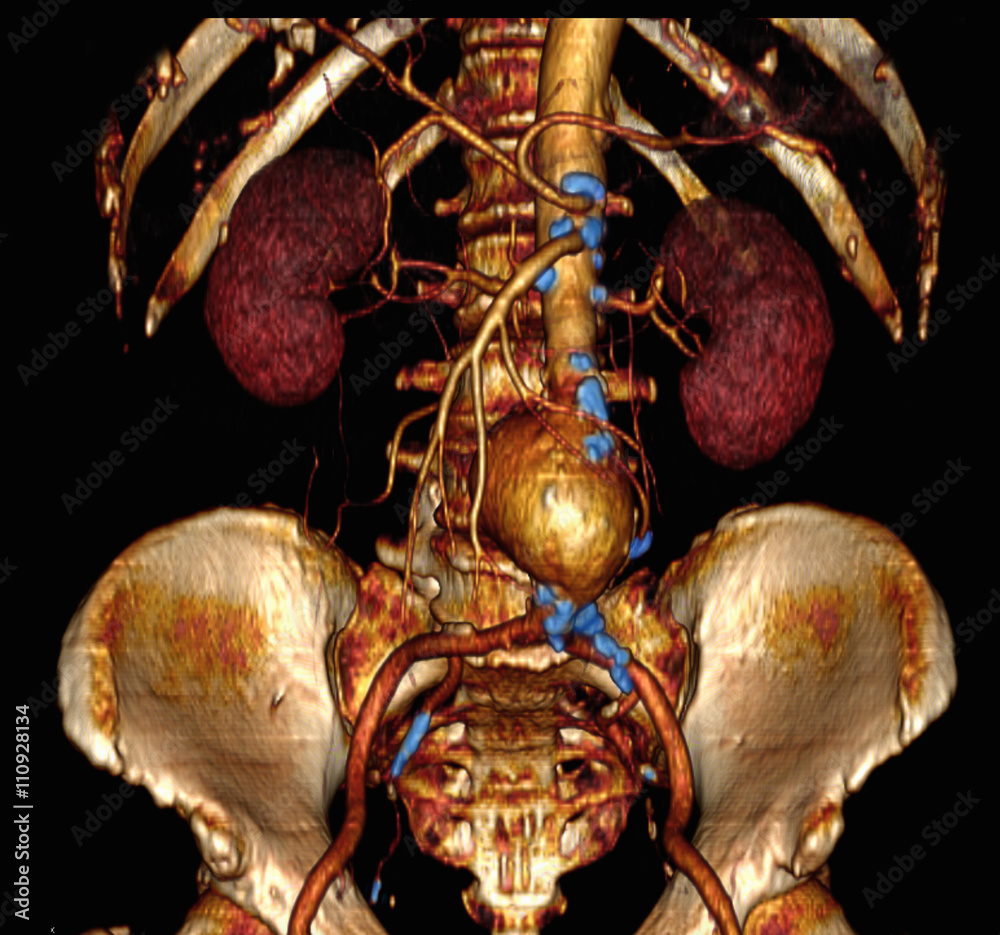 Three-dimensional abdominal angiographic CT scan showing a large ...