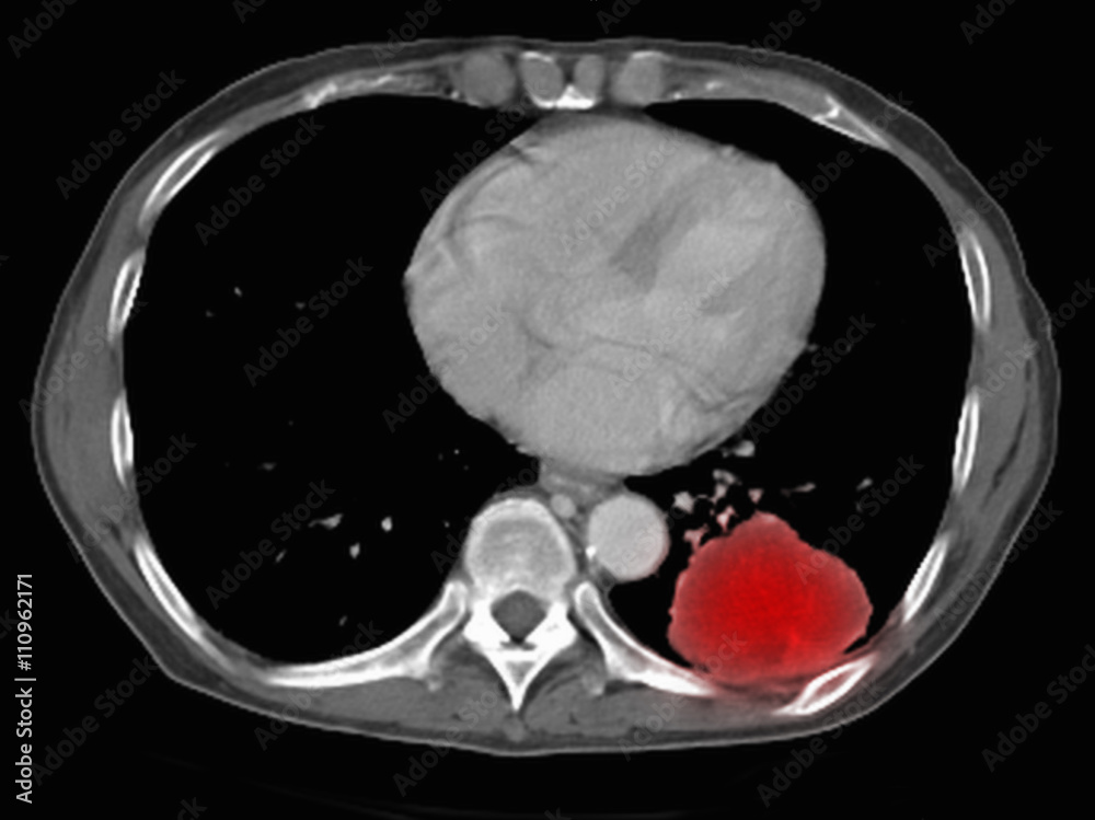 Image from a co-registered PET-CT study from dual modality scanner ...