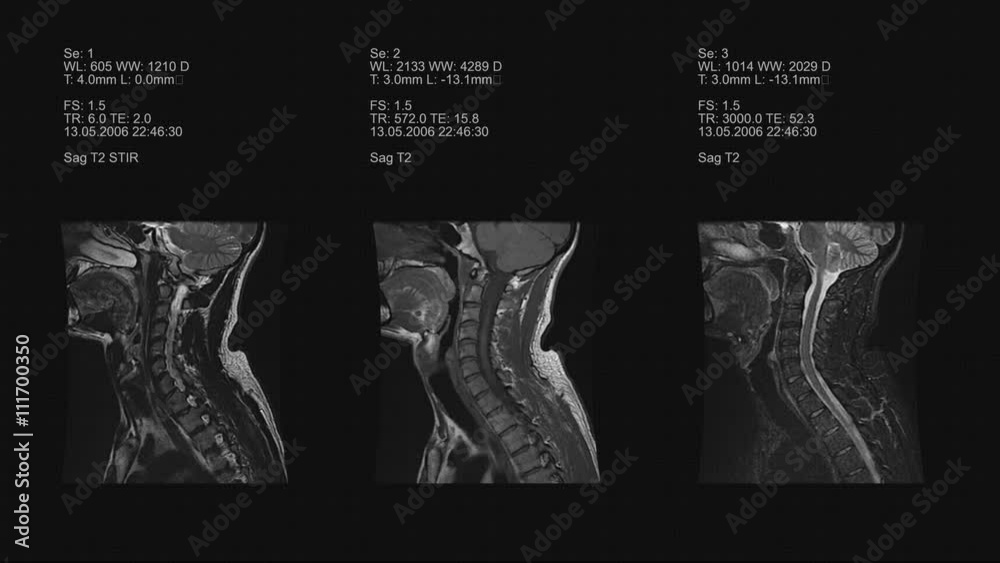 Vidéo Stock 4k set of three neck views of MRI scan. Loopable. Black and ...