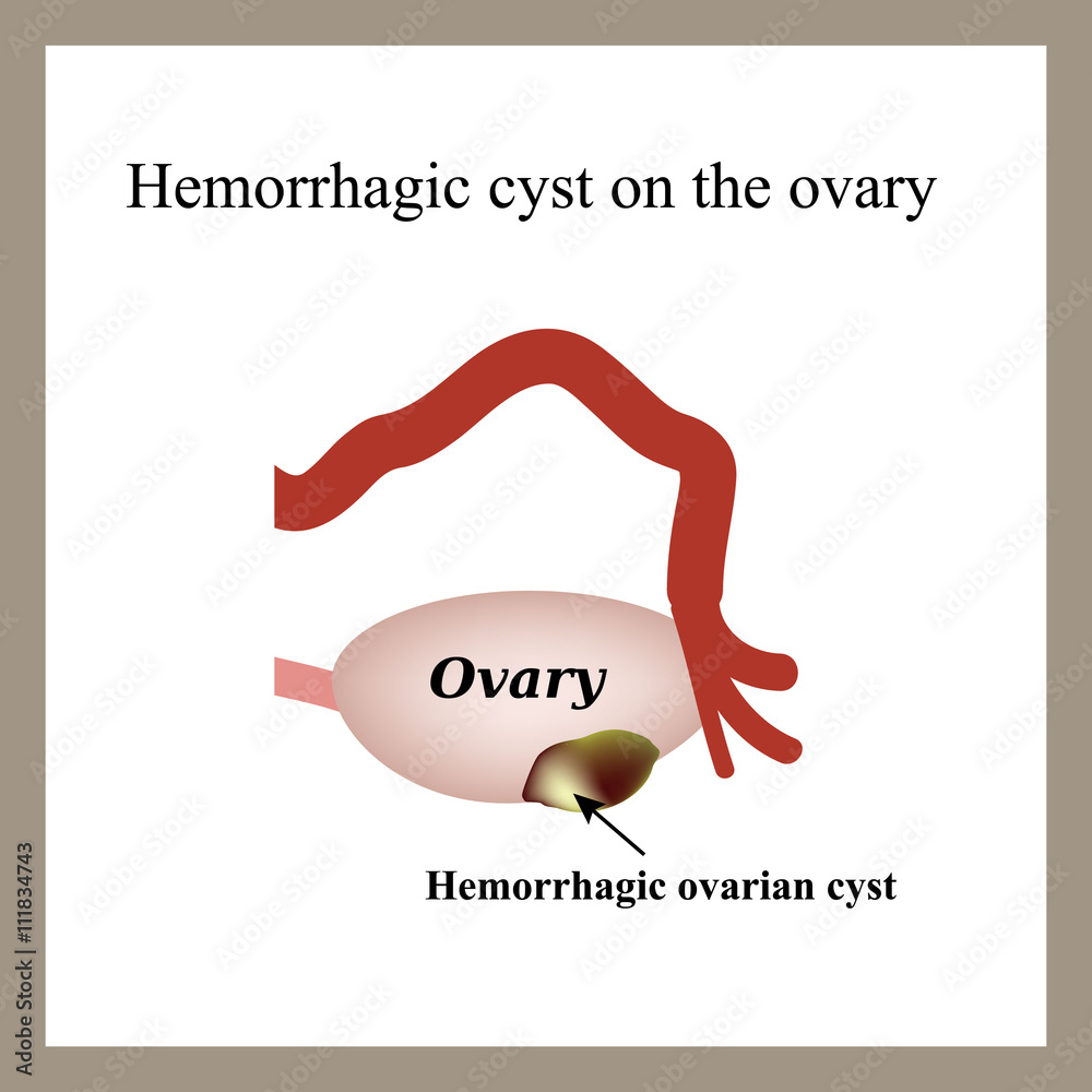 Hemorrhagic cyst on the ovary. Ovary. Infographics. Vector illustration ...