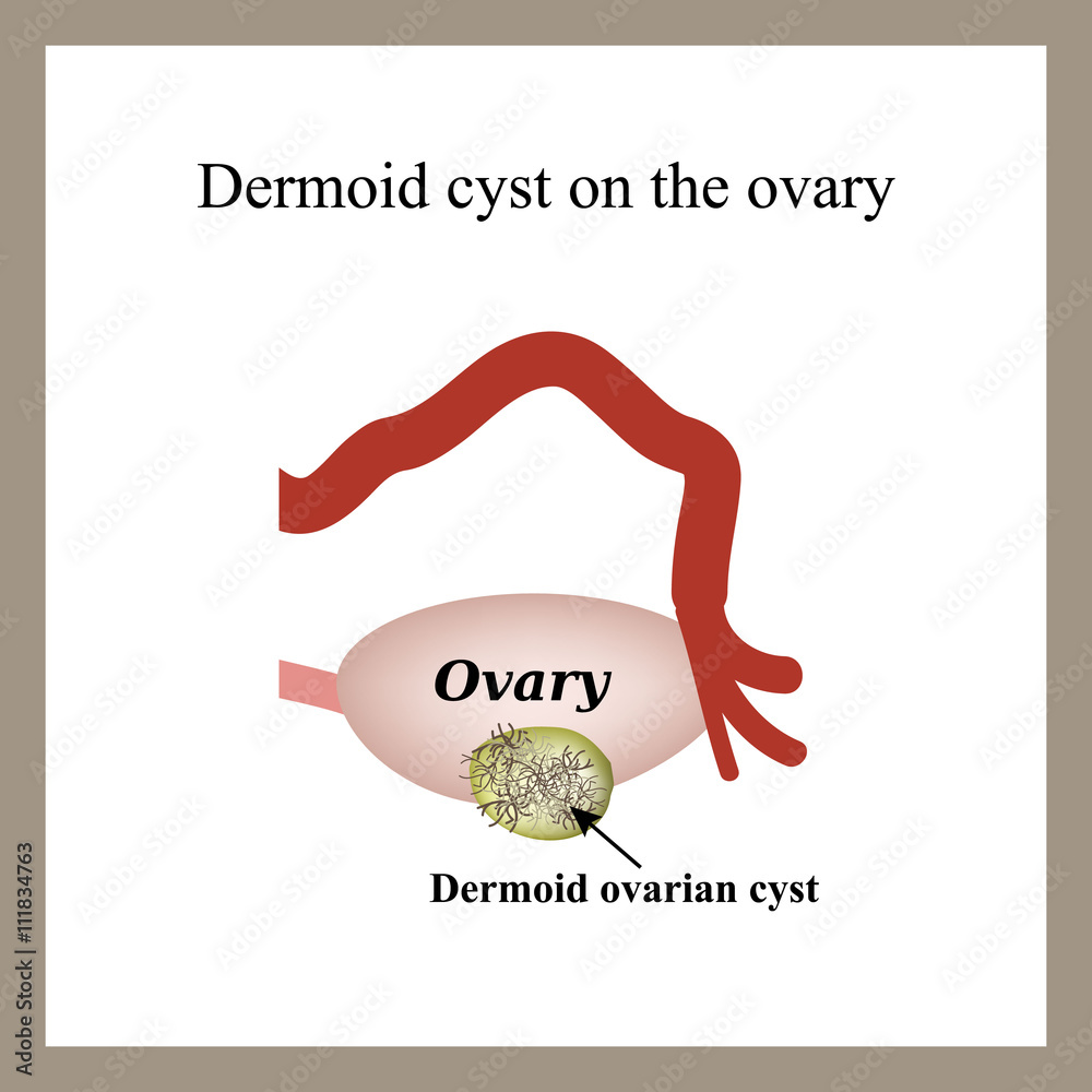Dermoid cyst on the ovary. Ovary. Infographics. Vector illustration on ...