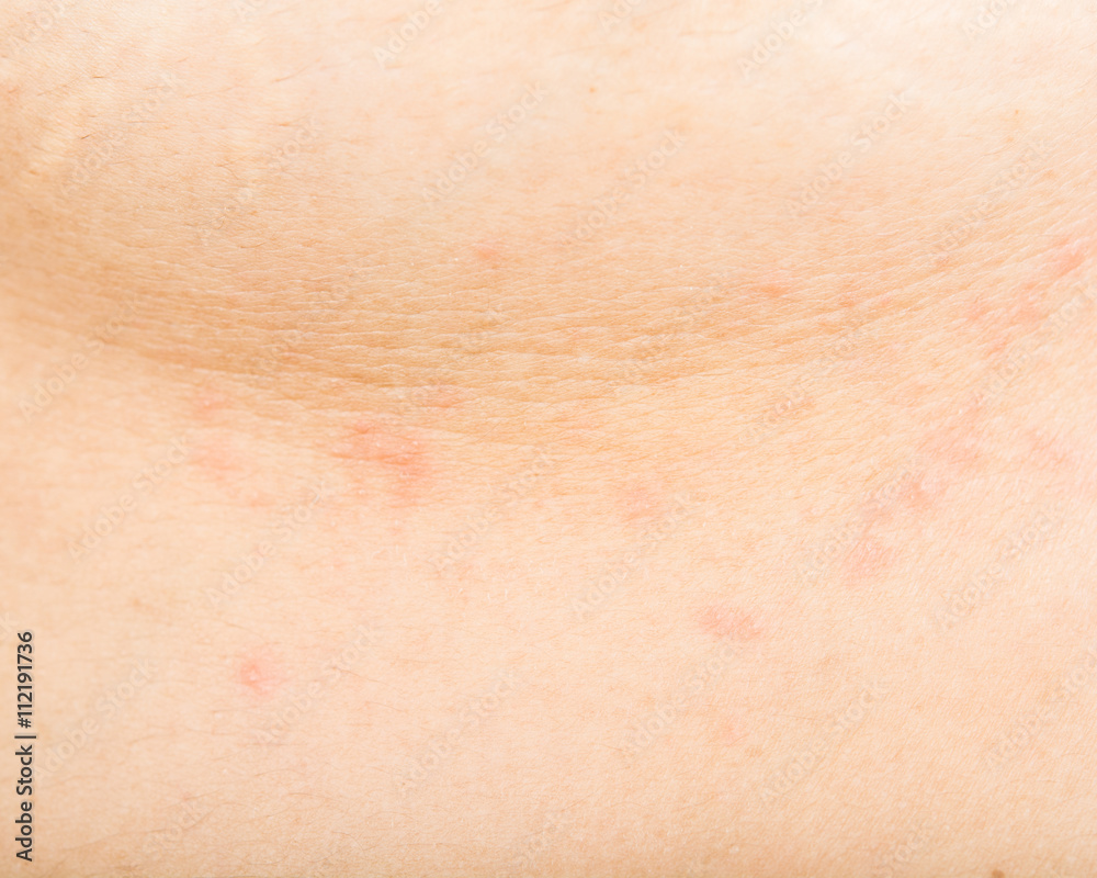 rashes in skin foto de Stock | Adobe Stock