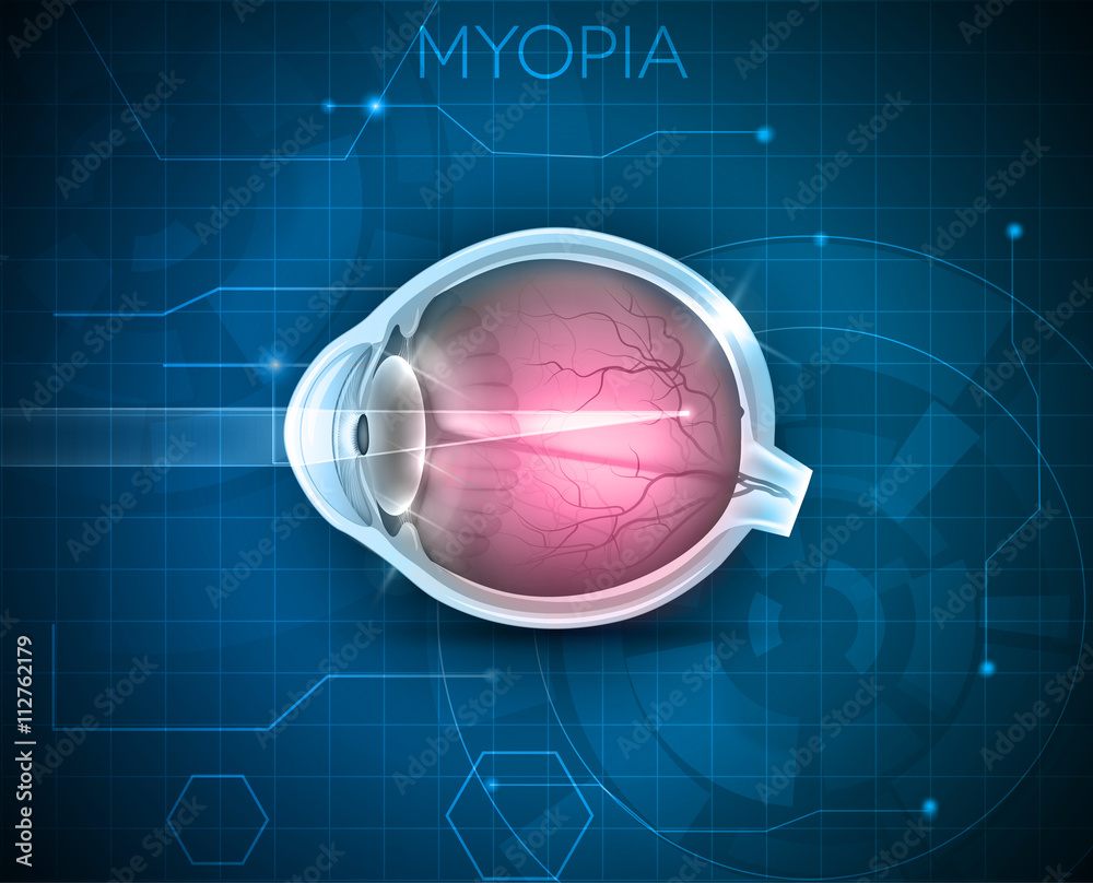 Myopia, vision disorder on a blue technology background. Myopia is ...
