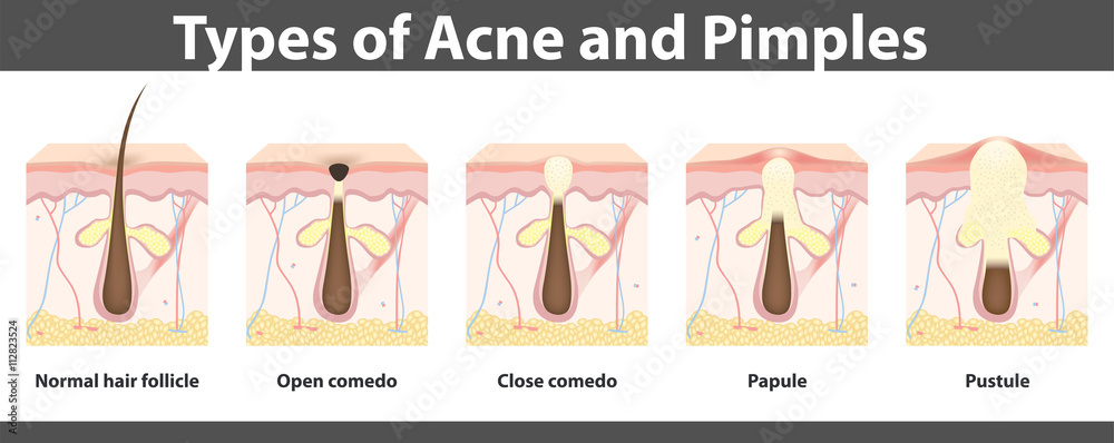 Types of acne, structure of pimple, vector illustration Stock Vector ...